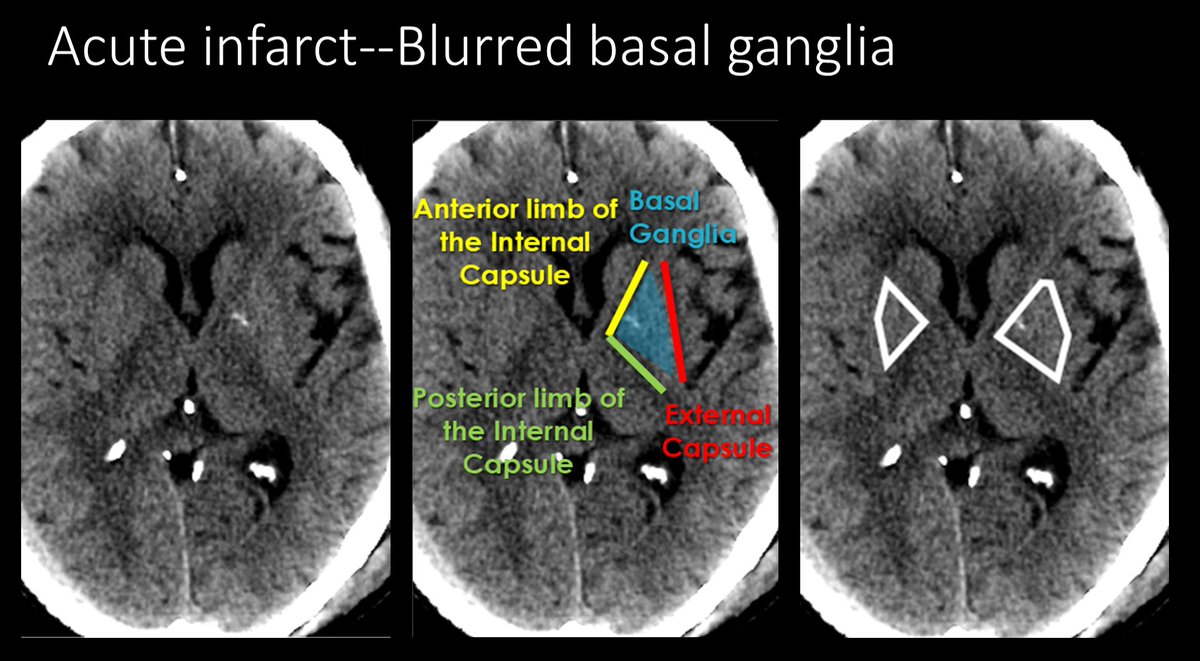 1/Time is brain! So you don’t have time to struggle w/that "stroke ...