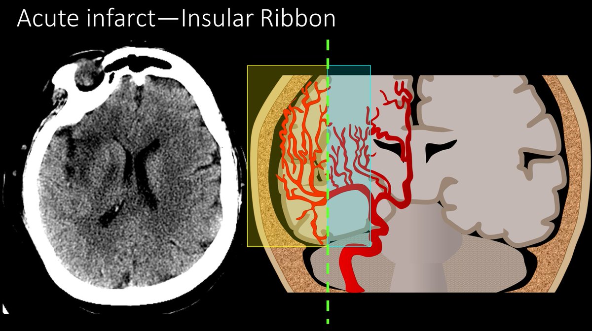 1/Time is brain! So you don’t have time to struggle w/that "stroke ...