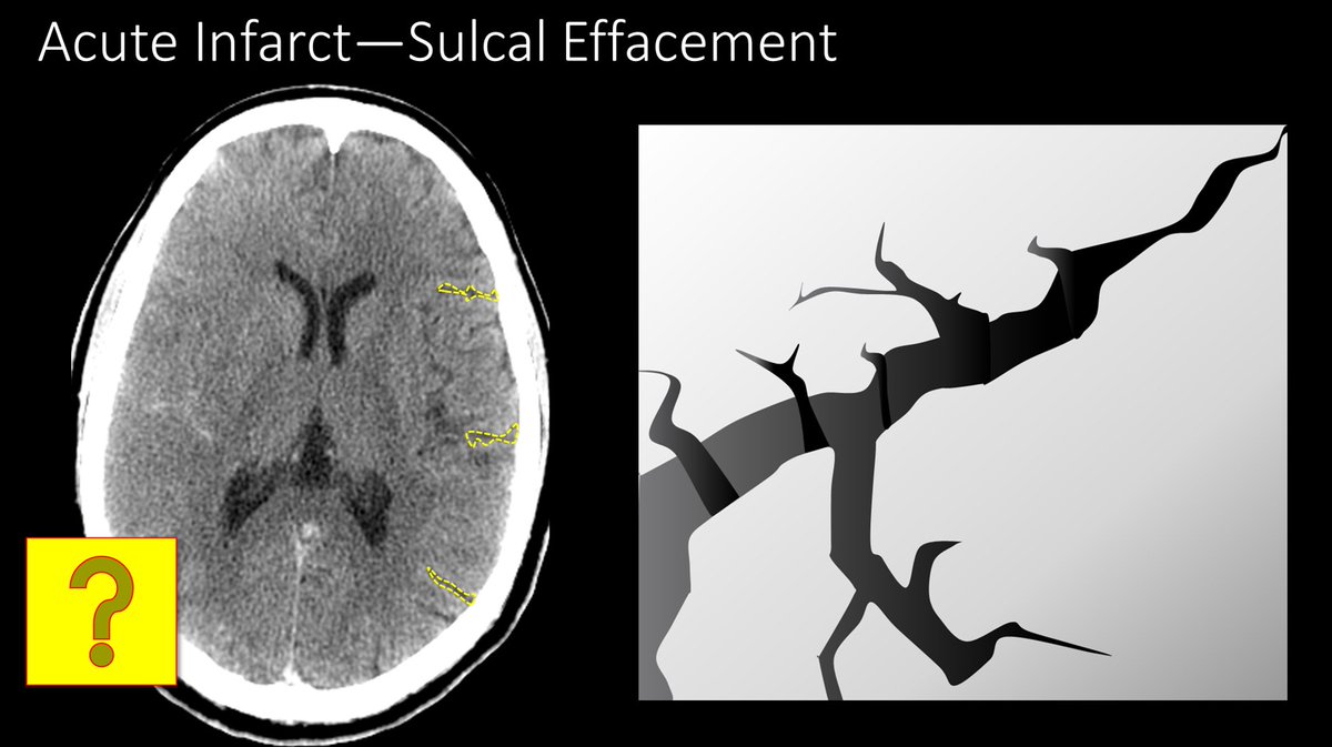 1/Time is brain! So you don’t have time to struggle w/that "stroke ...
