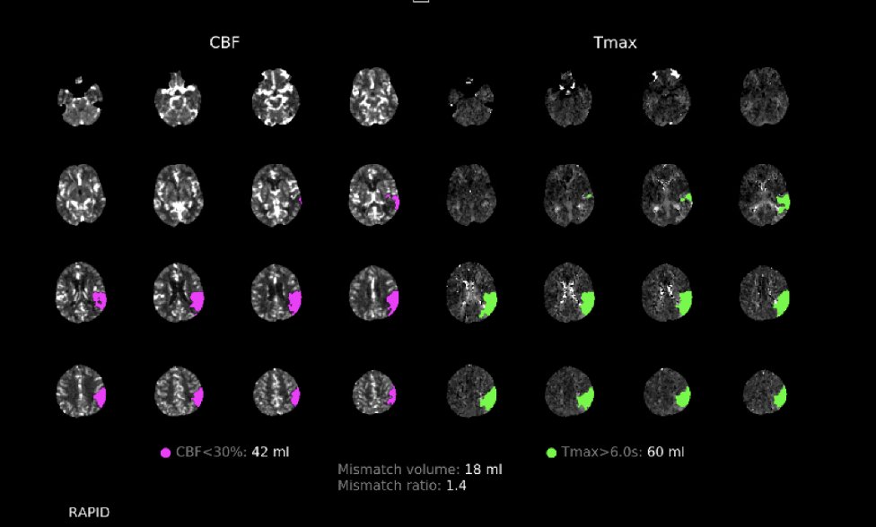 1/ Boo! 👻 Realized I forgot to post the final July #NeuroPostItPearls ...