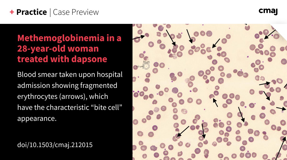 Methemoglobinemia Cell
