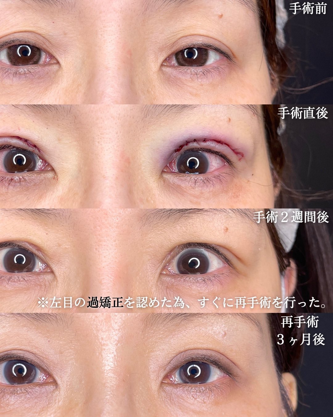 外崎麻里 モティーフ銀座 On Twitter 【眼瞼下垂自院修正】 切らない眼瞼下垂を3回受けていた方です。過去の糸を全て抜去し目の開きを邪魔してるツッパリを解除しました。 直後は左右差