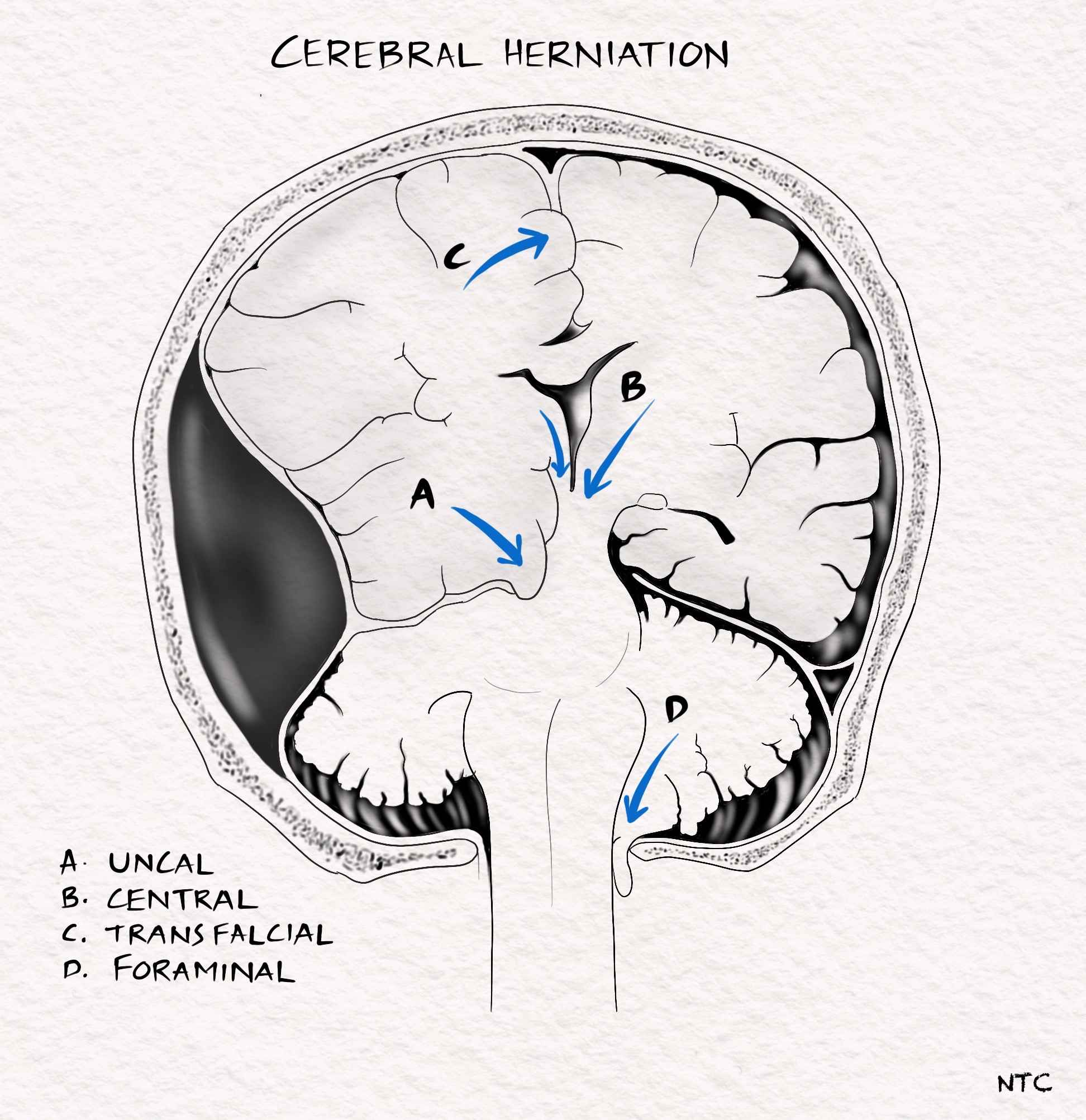 Uncal Herniation