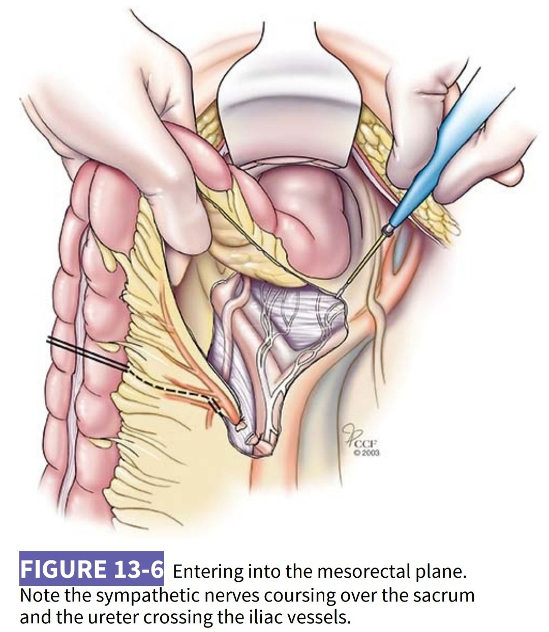 Total Mesorectal Excision