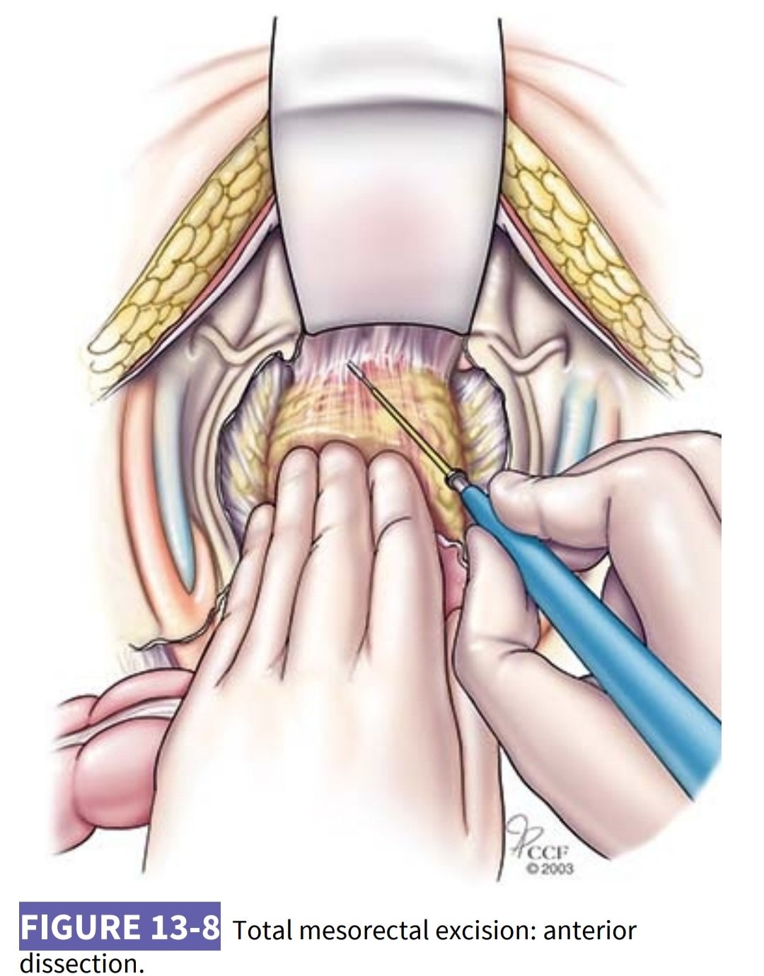Total Mesorectal Excision