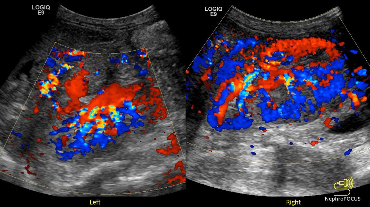 Renal #POCUS from a middle aged pt with chronic Foley presenting with ...