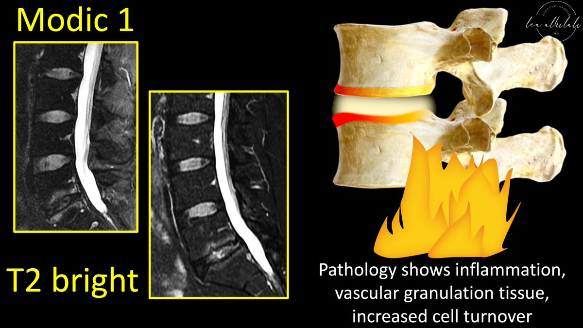 1/Do you feel there’s a back-log of findings in a spine MRI report ...