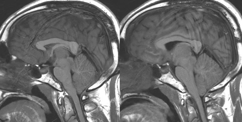 Intracranial HYPOtension, imaging findings and diagnostic approach ...