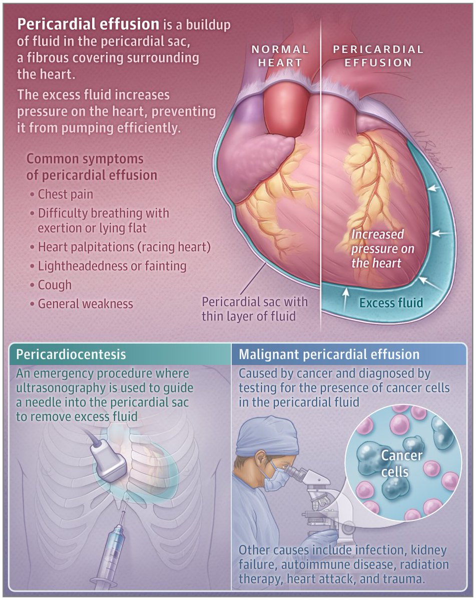 Pericardial Sac Comprehensive Overview Of Heart Anatomy | Galaxy.ai