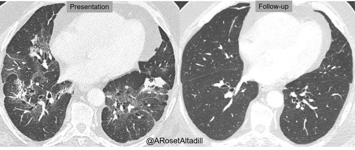#12 The Many Faces of Organizing Pneumonia (OP) 🎭 1⃣ OP is a term used ...