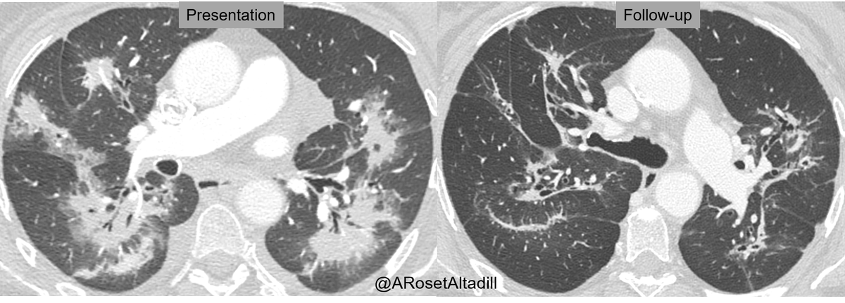 #12 The Many Faces of Organizing Pneumonia (OP) 🎭 1⃣ OP is a term used ...