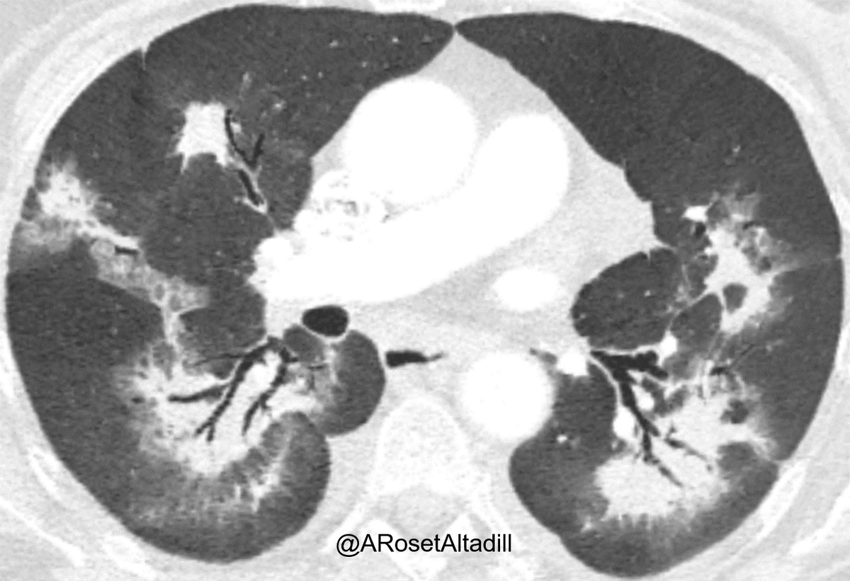 #12 The Many Faces of Organizing Pneumonia (OP) 🎭 1⃣ OP is a term used ...