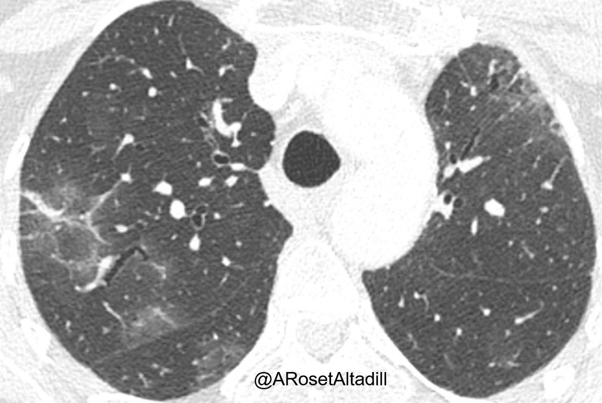 #12 The Many Faces of Organizing Pneumonia (OP) 🎭 1⃣ OP is a term used ...