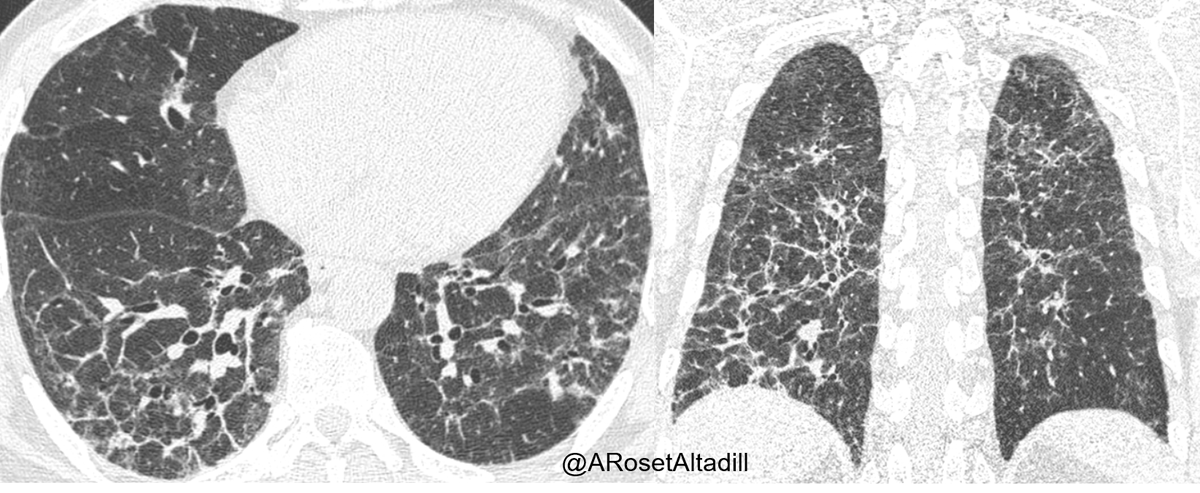 #12 The Many Faces of Organizing Pneumonia (OP) 🎭 1⃣ OP is a term used ...