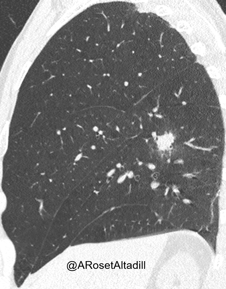 #12 The Many Faces of Organizing Pneumonia (OP) 🎭 1⃣ OP is a term used ...