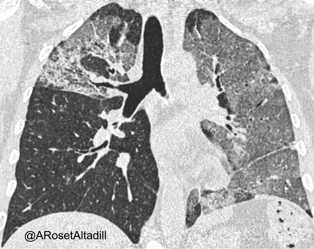 #12 The Many Faces of Organizing Pneumonia (OP) 🎭 1⃣ OP is a term used ...