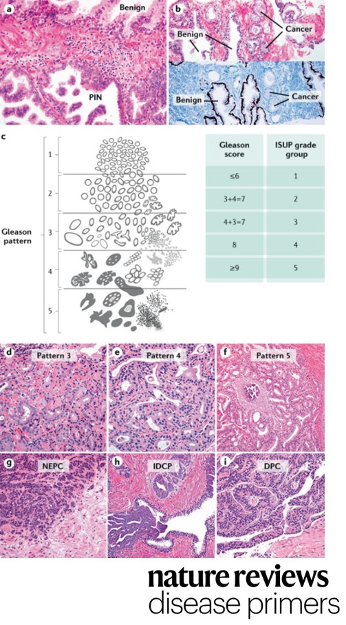 Prostate Cancer Histological Grades