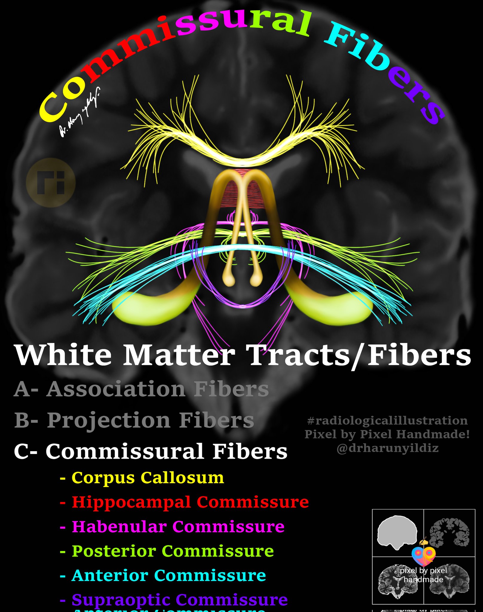 Posterior Commissure
