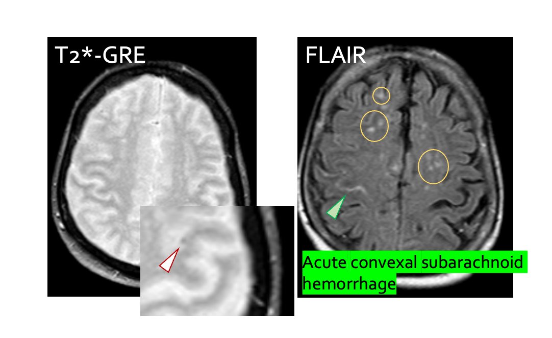 🚀🧠Meta-tweetorial - join me (🧔🏻‍♂️) as we dissect @rkchoi's case tweet ...