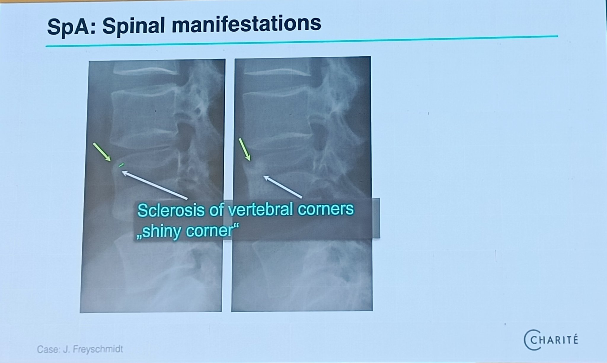 Syndesmophytes Image Based Question 72002 New