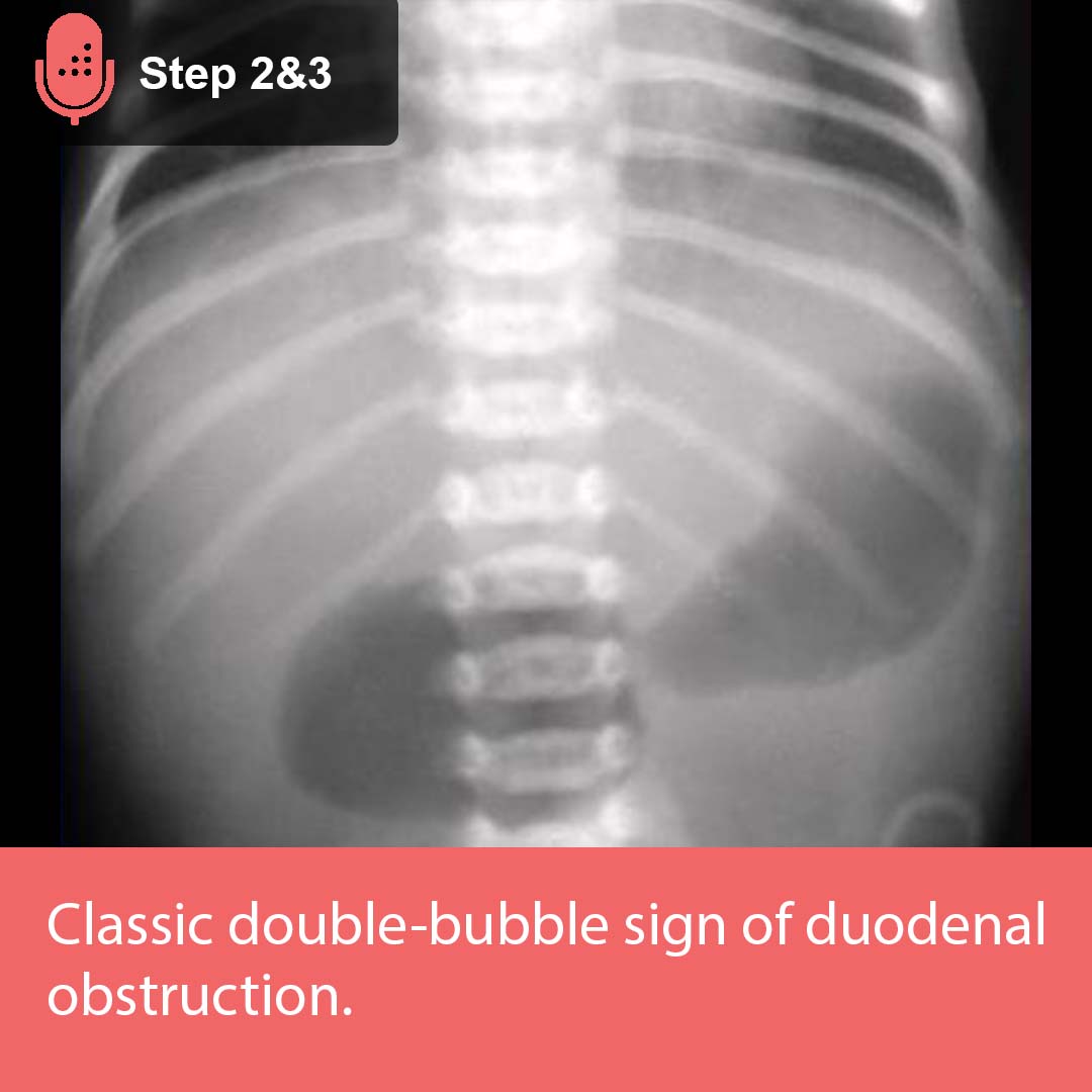 Annular Pancreas Double Bubble