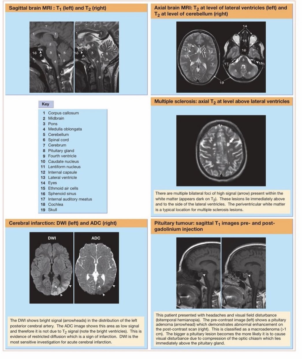 Oren Gottfried Md On Twitter A Basics Of Reading Brain Mri From Radiologic World T