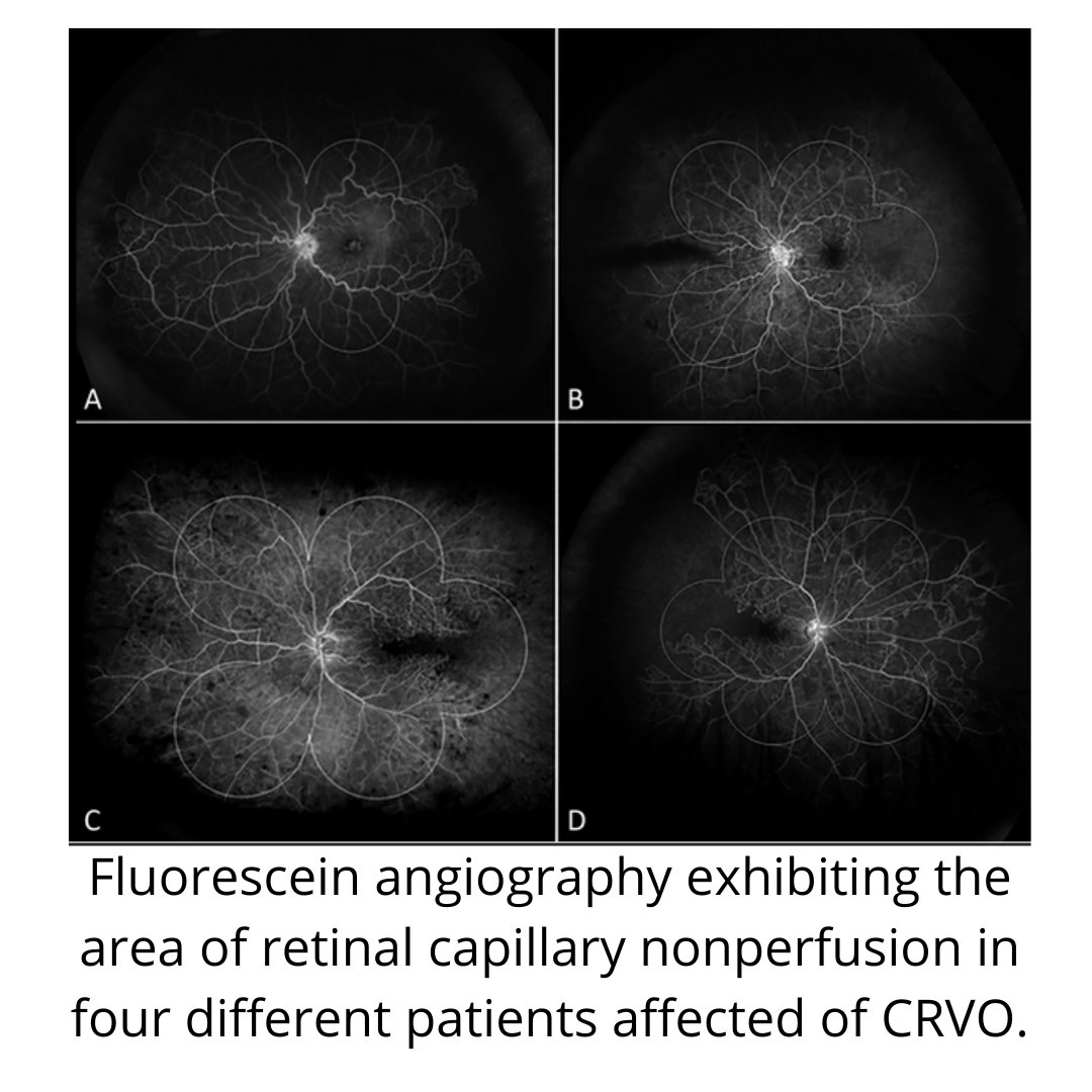 Retina on Twitter: "OPEN ACCESS RETINAL NONPERFUSION IN THE EARLY TREATMENT DIABETIC RETINOPATHY ...