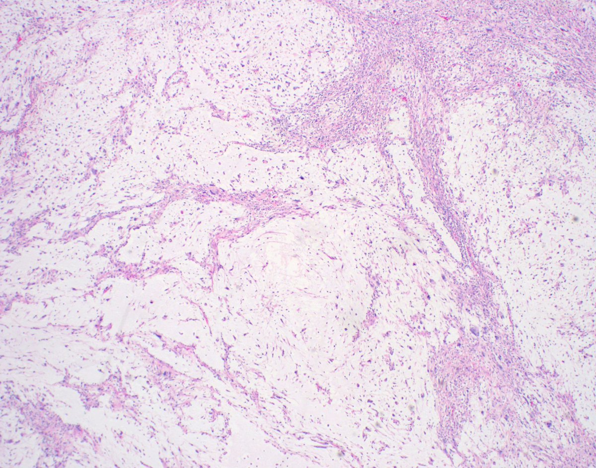 Jerad Gardner Md On Twitter Subcutaneous Thigh Mass In Elderly Adult Your Diagnosis Answer