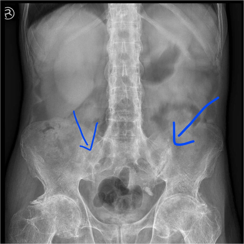 Sacroiliac Joint X Ray