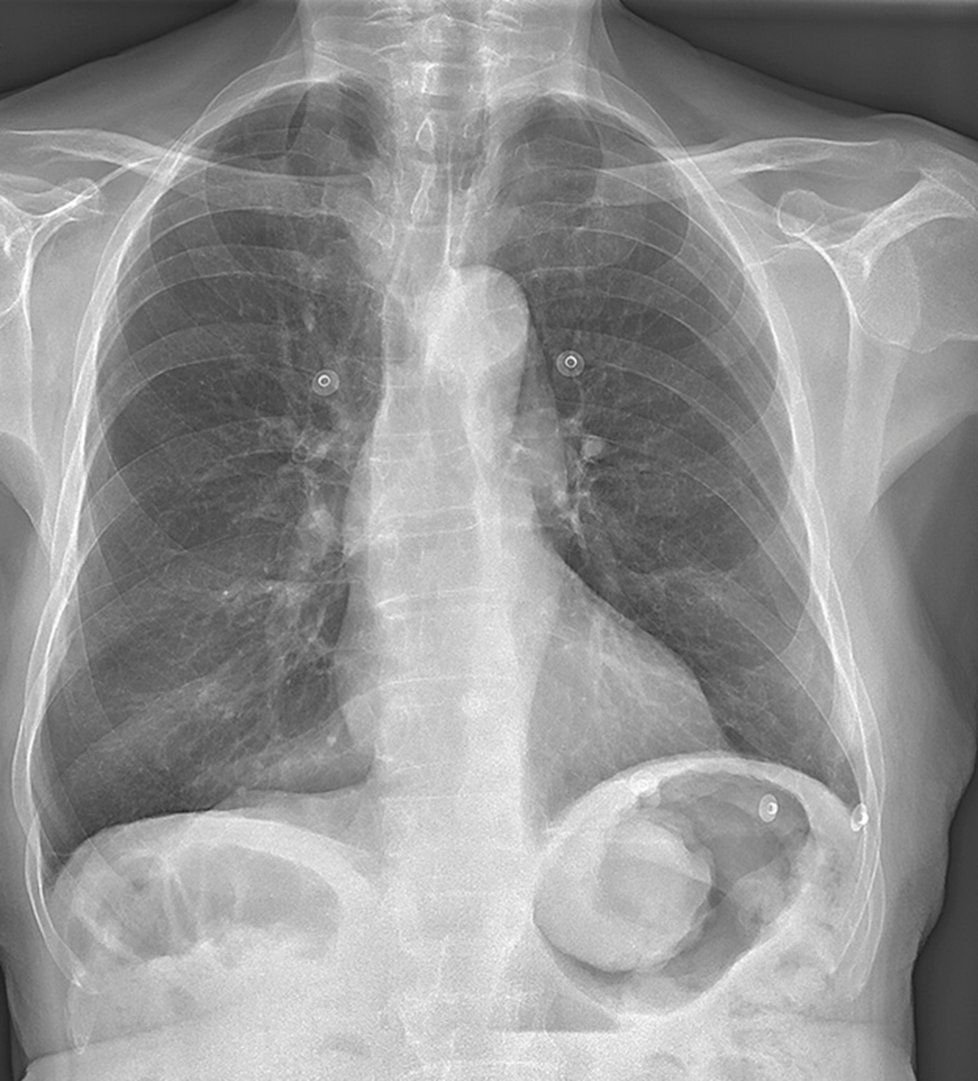 Chest Xray Abnormal