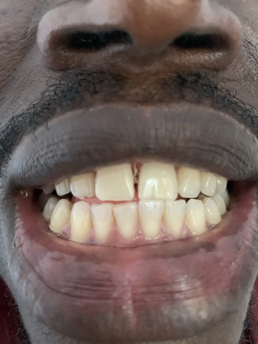 The recommended SOLUTION for a MISSING TOOTH. If you have lost a tooth ...