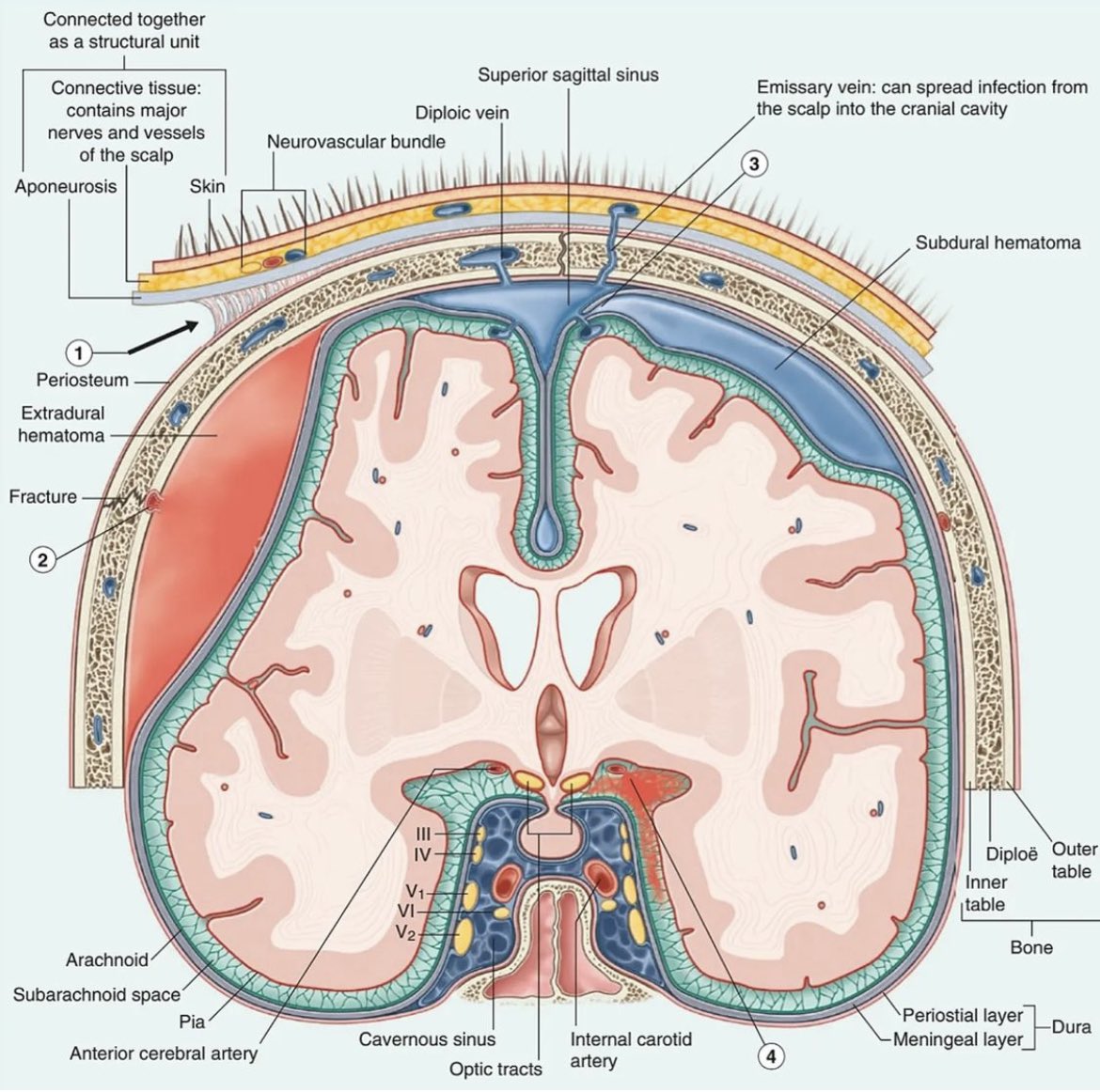 Epidural Brain