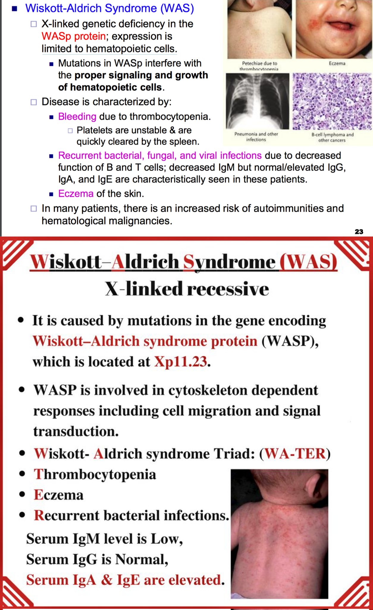 Wiskott Aldrich Syndrome Symptoms