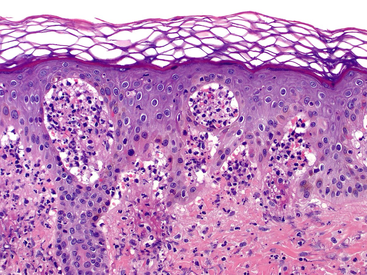 Dermatitis Herpetiformis Histology