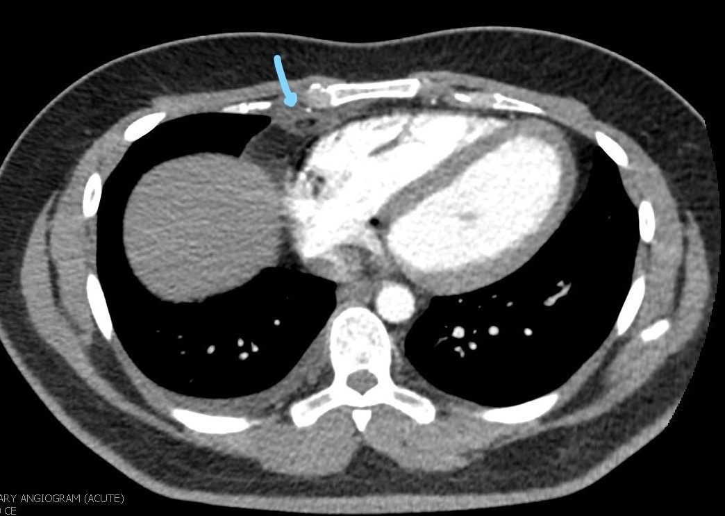 Bharti Khurana Md Facr On Twitter Epipericardial Fat Necrosis Presenting With Acute Chest