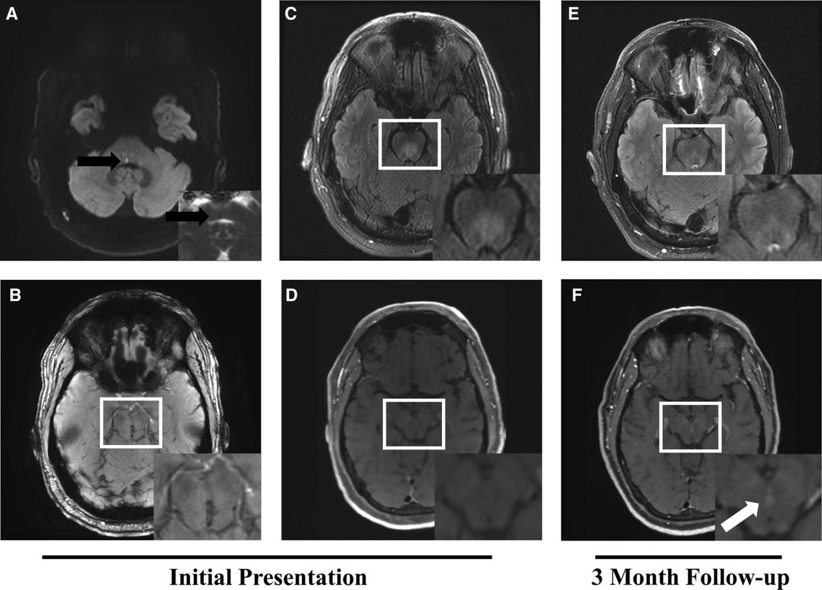 Stroke AHA ASA On Twitter Stroke Images Thrombosed Developmental stroke-aha-asa-on-twitter-stroke-images-thrombosed-developmental