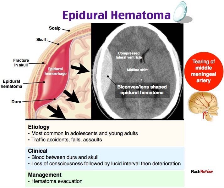 Epidural Hemorrhage