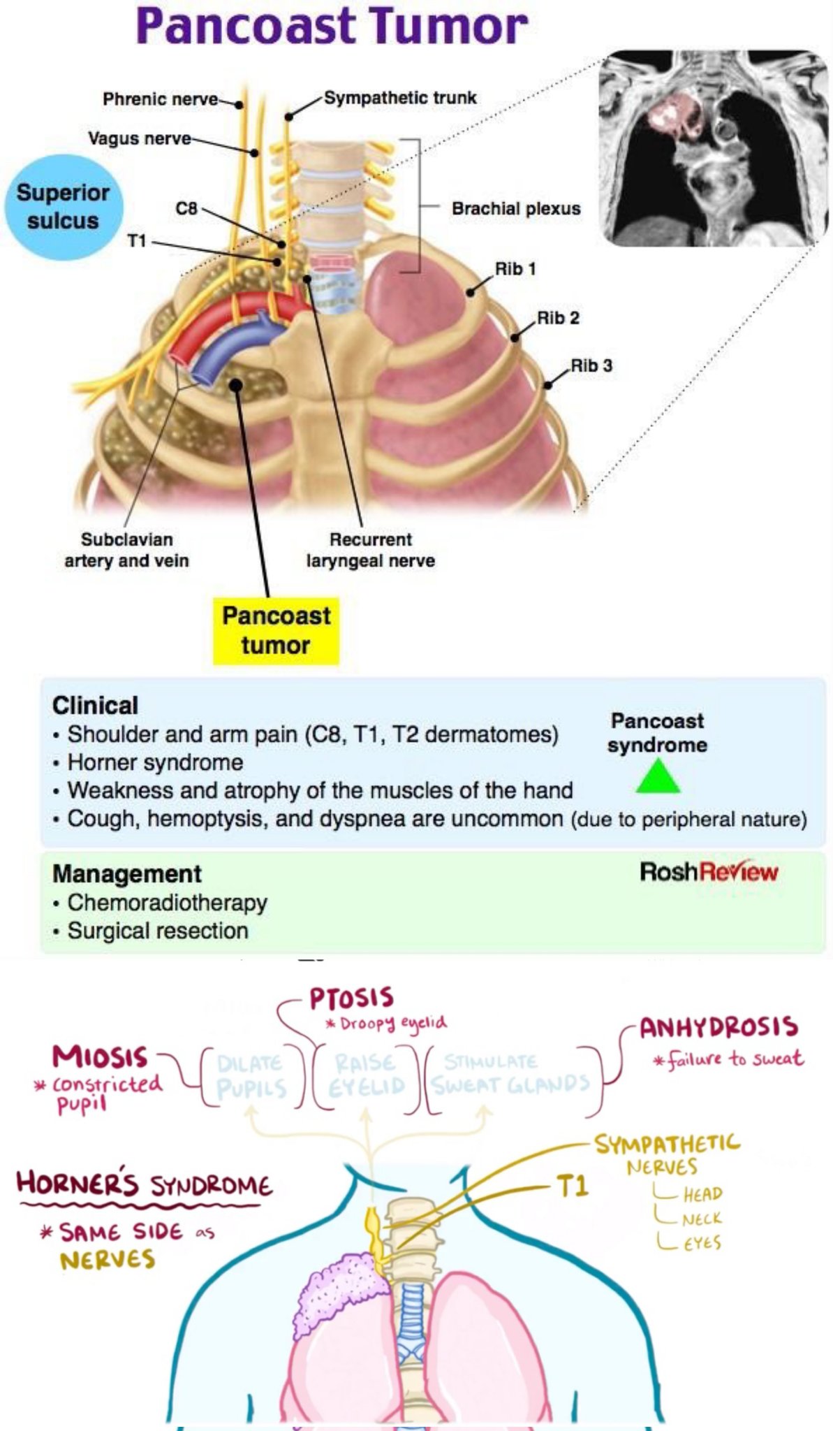 Pancoast Tumor Neck