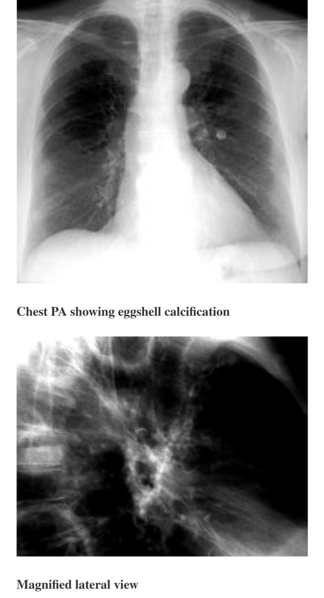 Eggshell Calcification