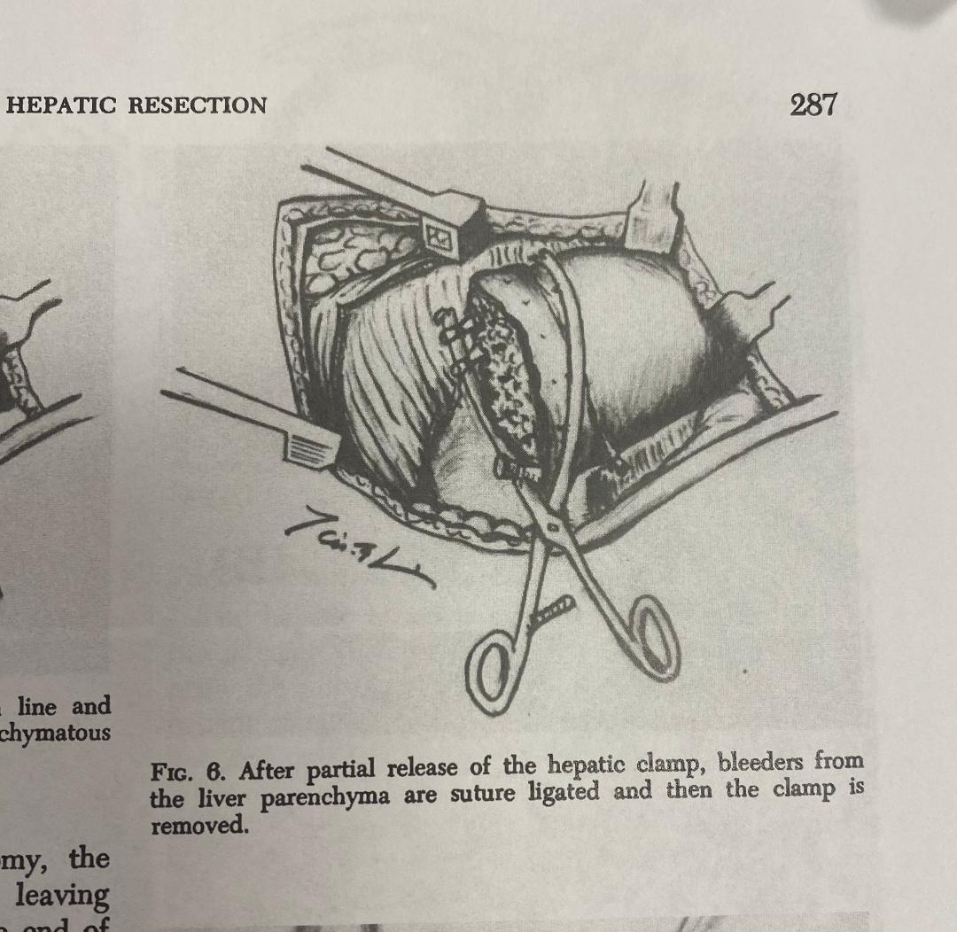Different 🧵today... I looked at a large liver clamp that has been kept ...