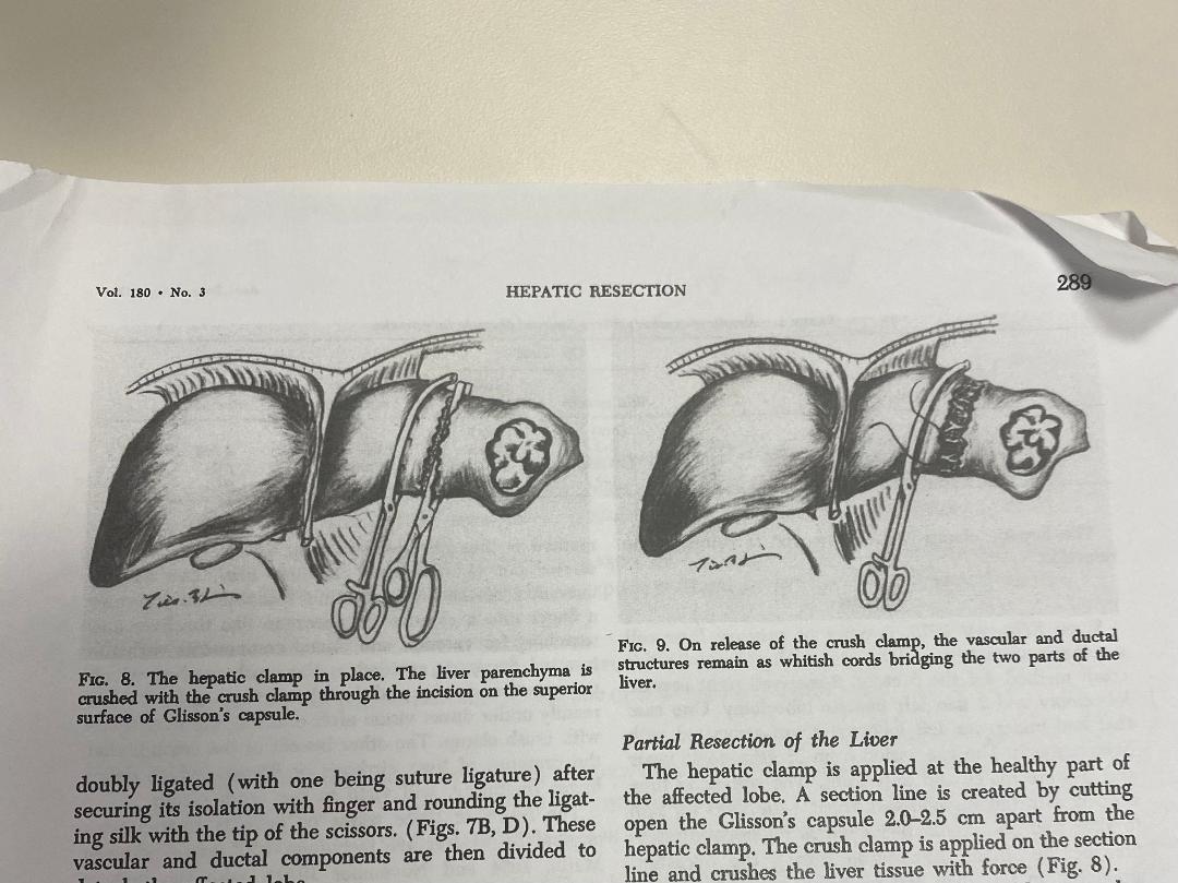 Different 🧵today... I looked at a large liver clamp that has been kept ...