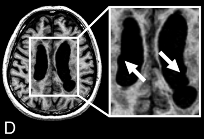 Features of Normal Pressure Hydrocephalus: 1/🧵 Evans Index >0.3 (x/y ...