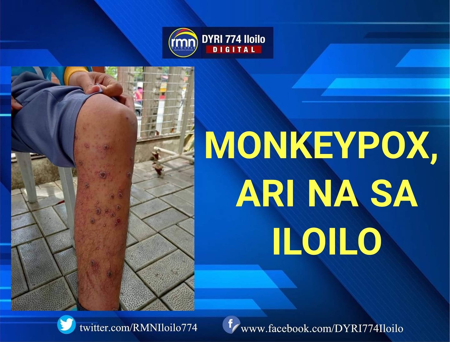 Dr. Guido David on Twitter: "Monkeypox case in Iloilo. I believe this is the 4th reported case ...