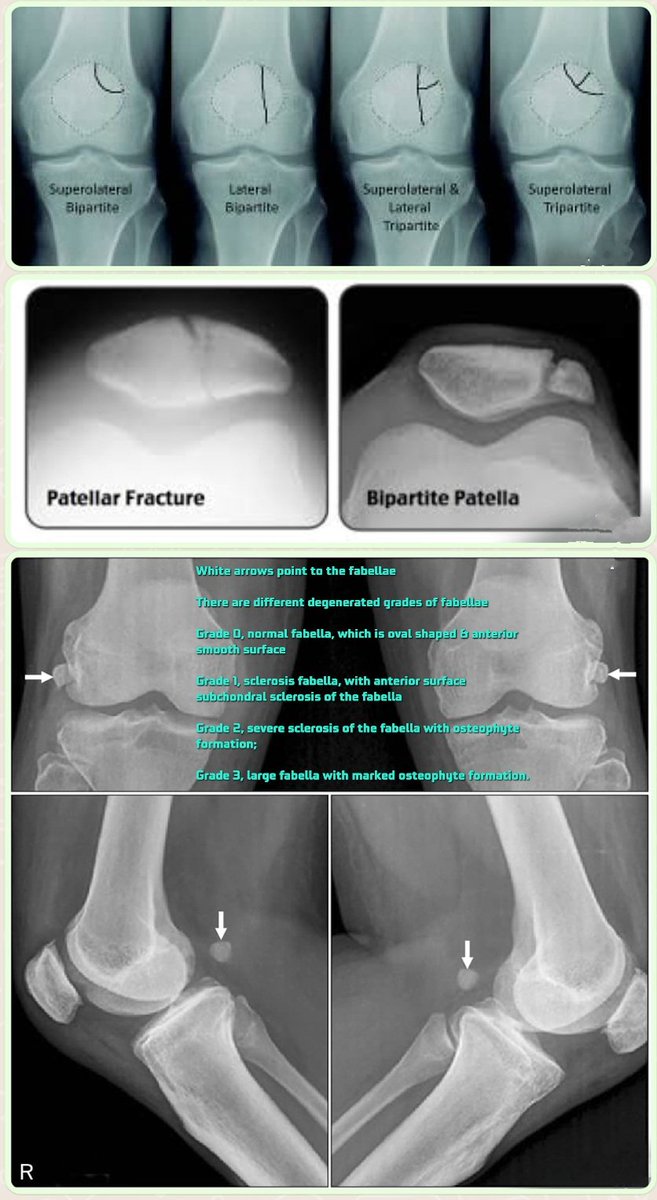 FULL TEXT Bipartite Patella Separation With Quadriceps, 50% OFF