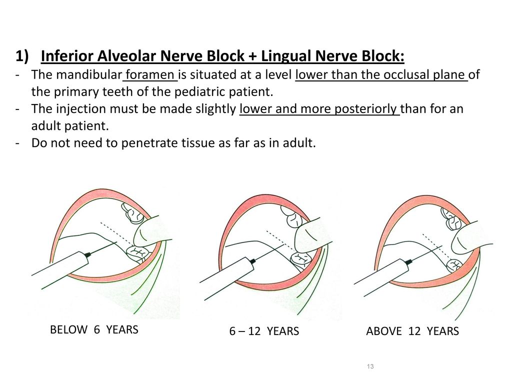 Inferior Alveolar Nerve Block In Children