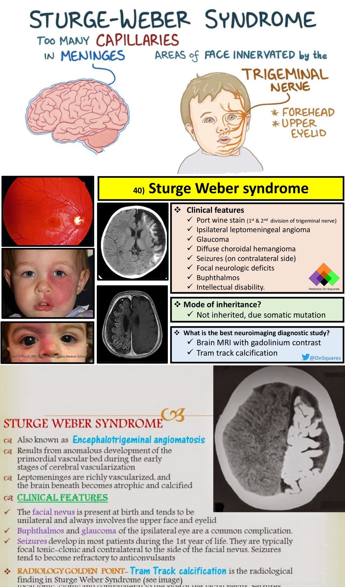 Sturge Weber Mri