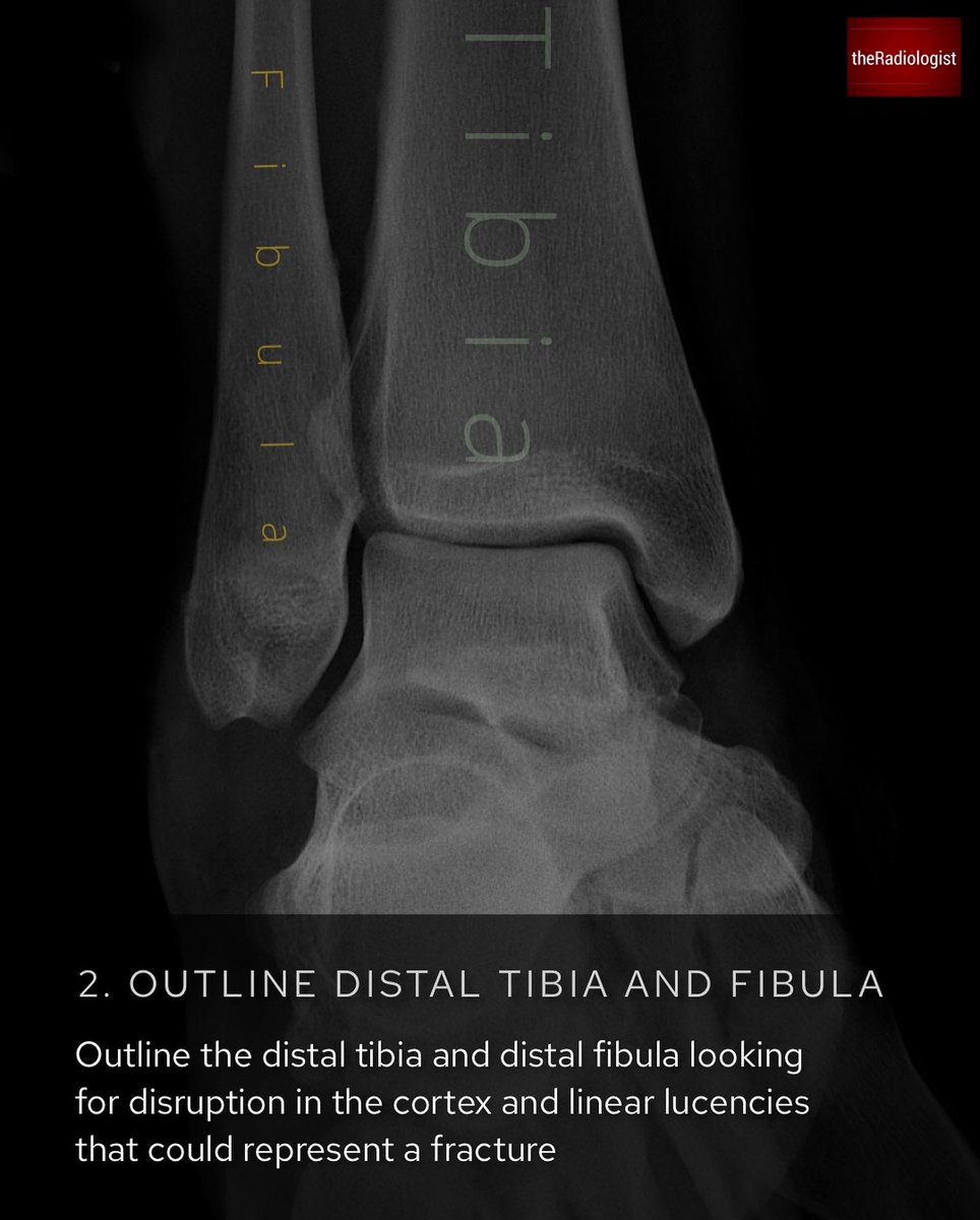 Ankle X-Ray mortise view: anatomy and strategy (1/3) - Thread from ...
