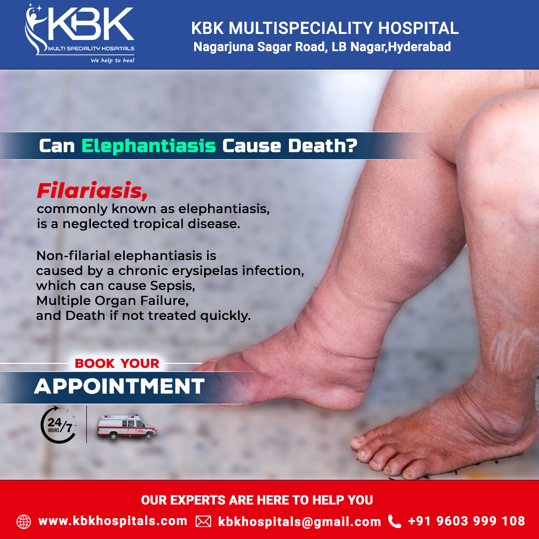 Elephantiasis Treatment