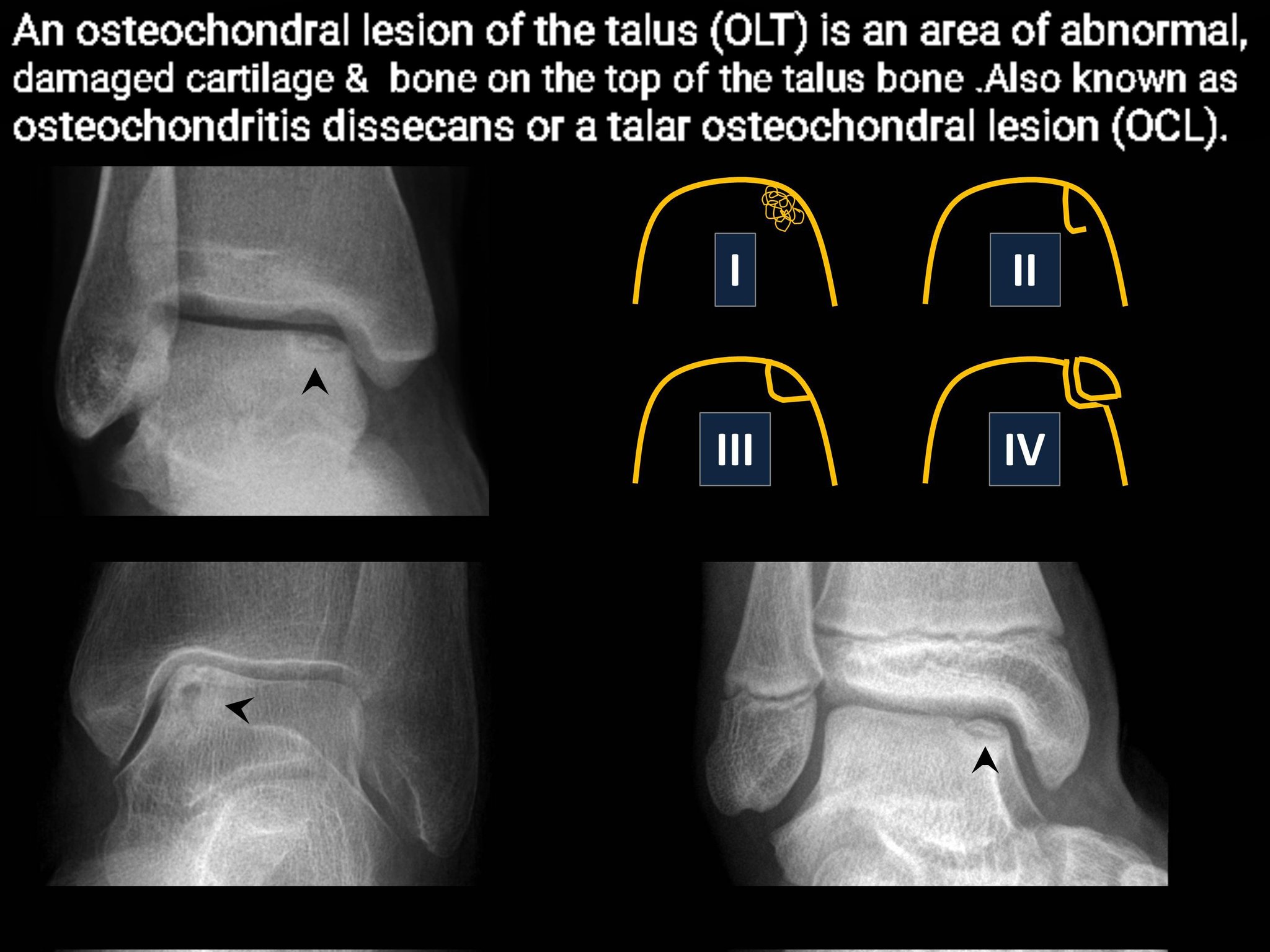 Osteochondral Lesion Of The Talus