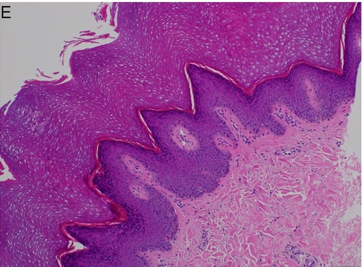 Acanthosis Histology